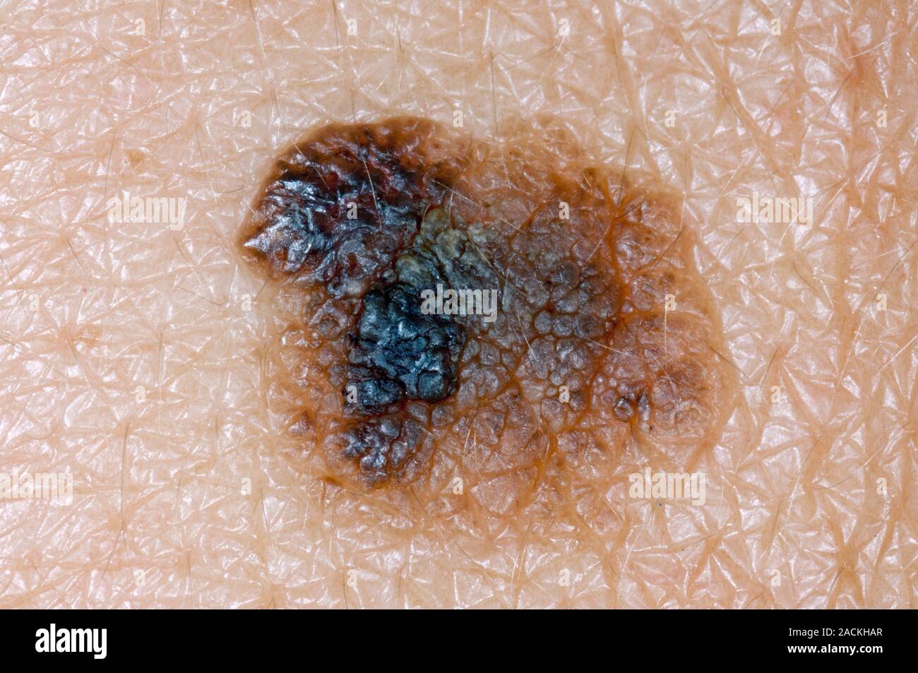 Close-up of a pigmented seborrheic wart on the skin in a 46 year old ...