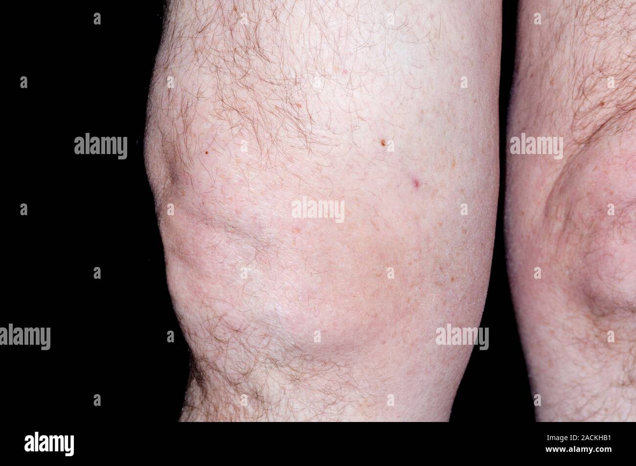 Swollen knee in a 63 year old male patient with osteoarthritis. This ...