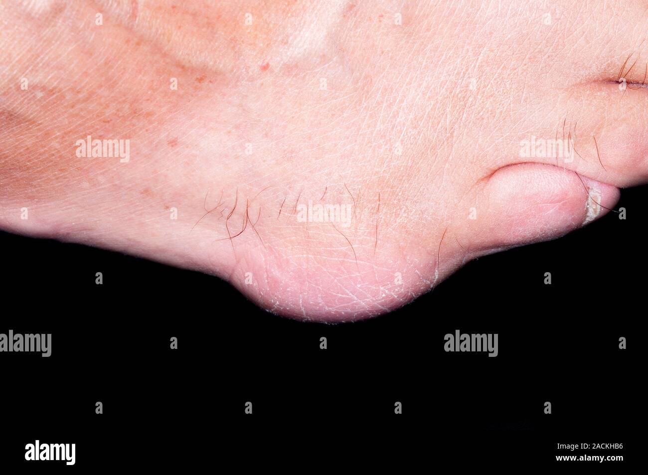 Red and swollen metatarsal-phalangeal joint of the fifth toe in a 61 ...