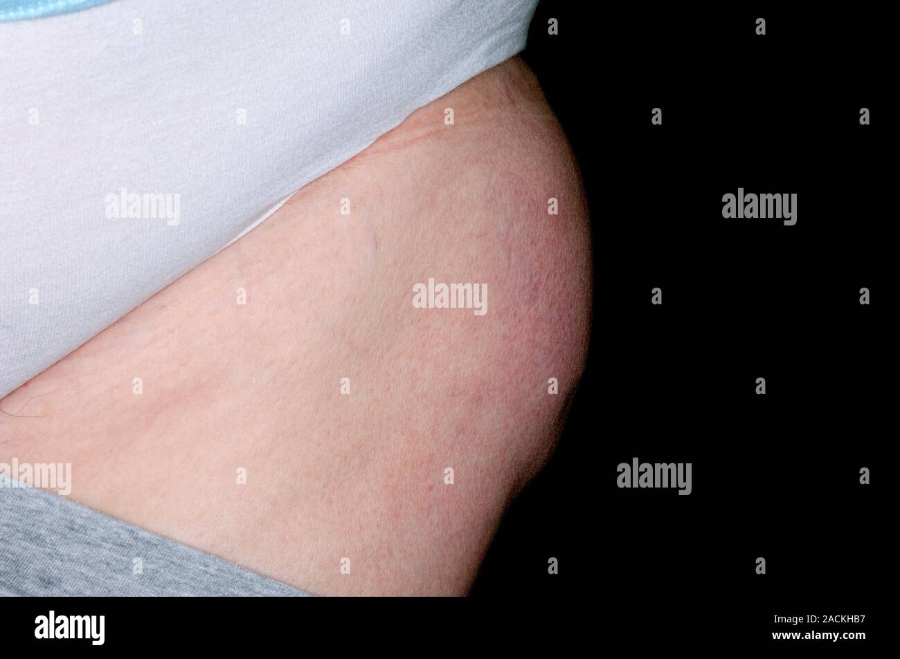 Red and swollen joint of the hip in a 72 year old female patient caused ...