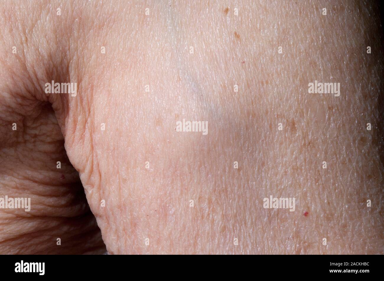 Swelling on the upper arm in an 86 year old female patient due to a ...