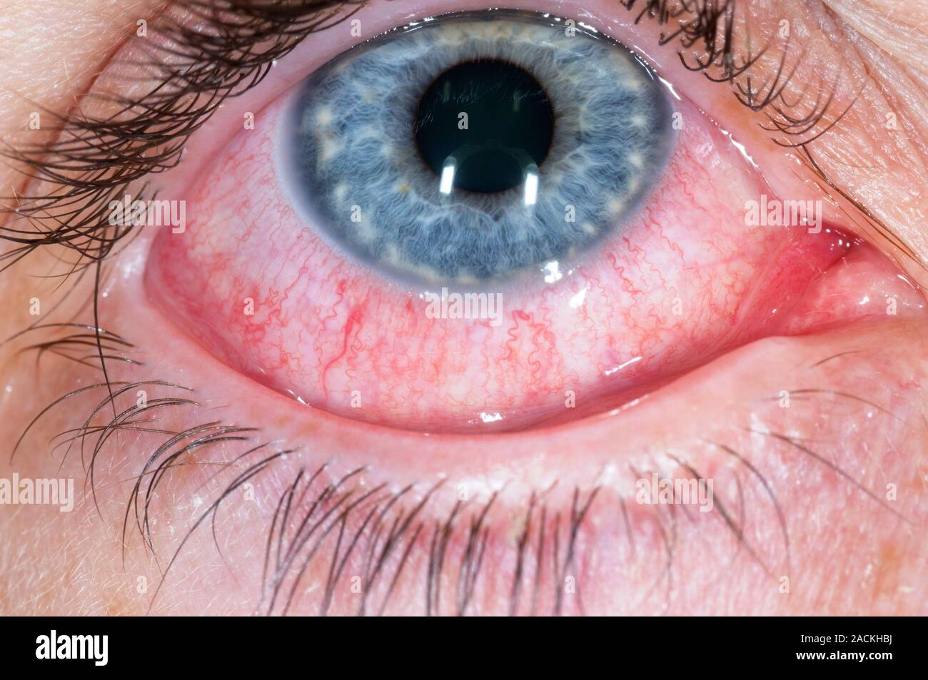 Close-up of the red and inflamed eye in a 36 year old female patient ...