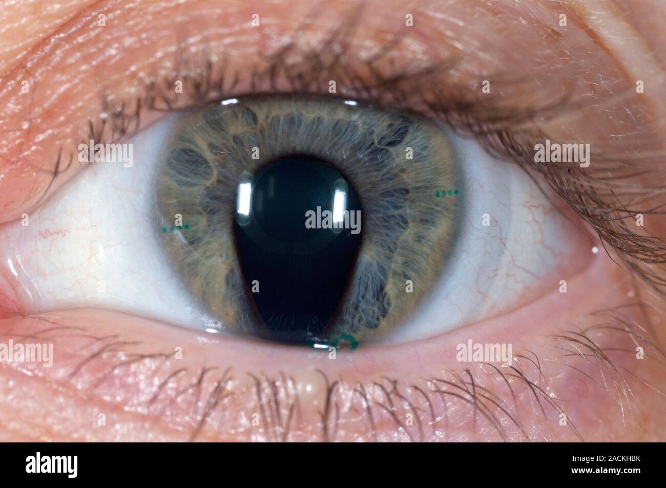 Close Up Of An Enlarged Pupil Extending To The Lower Edge Of The Iris Of The Eye In A 35 Year