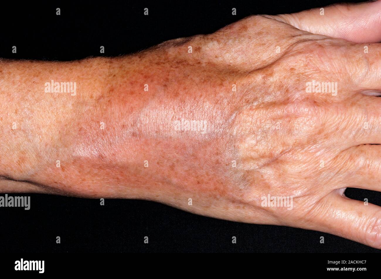 Bruising (haematoma) in the skin of the wrist in a 77 year old female ...