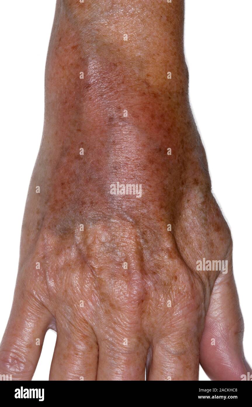 Bruising (haematoma) in the skin of the wrist in a 77 year old female ...
