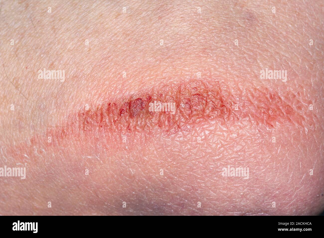 Close-up of a superficial graze of the skin on the elbow in a 50 year ...