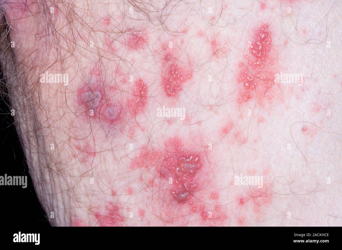 Close Up Of A Shingles Rash Of Blisters On The Skin Of The Leg In An 85 Year Old Male Patient