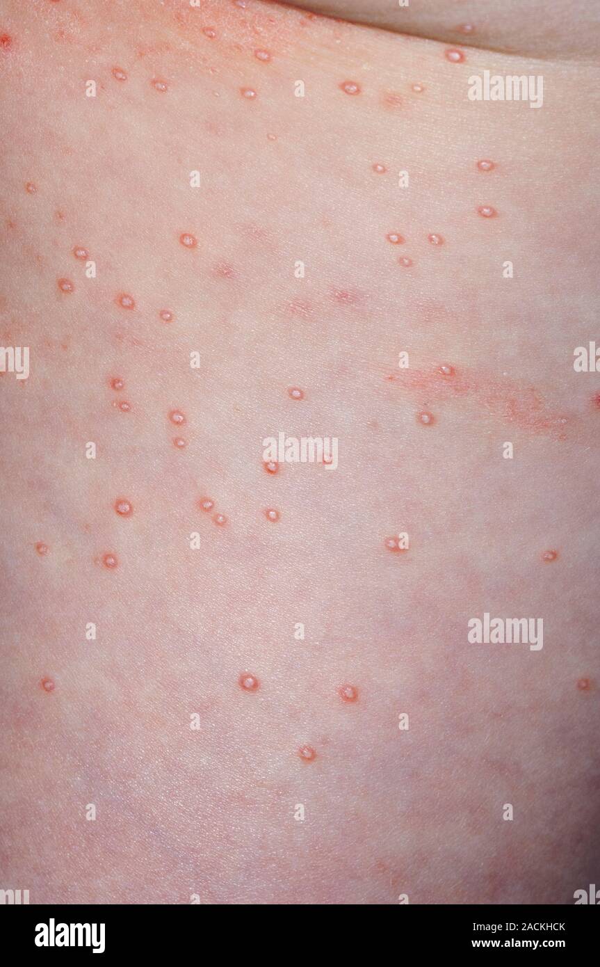 Molluscum contagiosum skin infection on the back of the thigh in a 5 ...