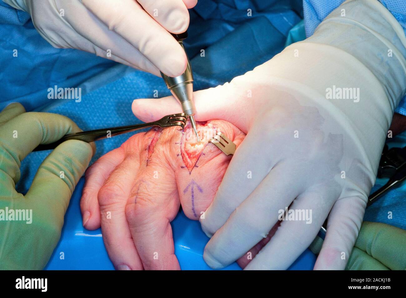 Knuckle joint replacement surgery. Orthopaedic surgeons carrying out a ...