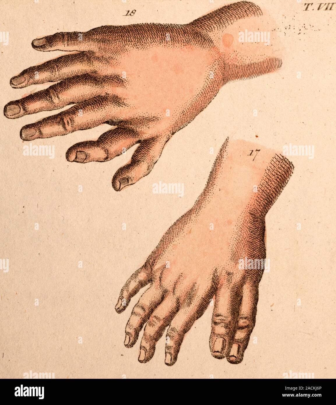 Polydactyly - extra fingers. 18th century illustration, copperplate ...