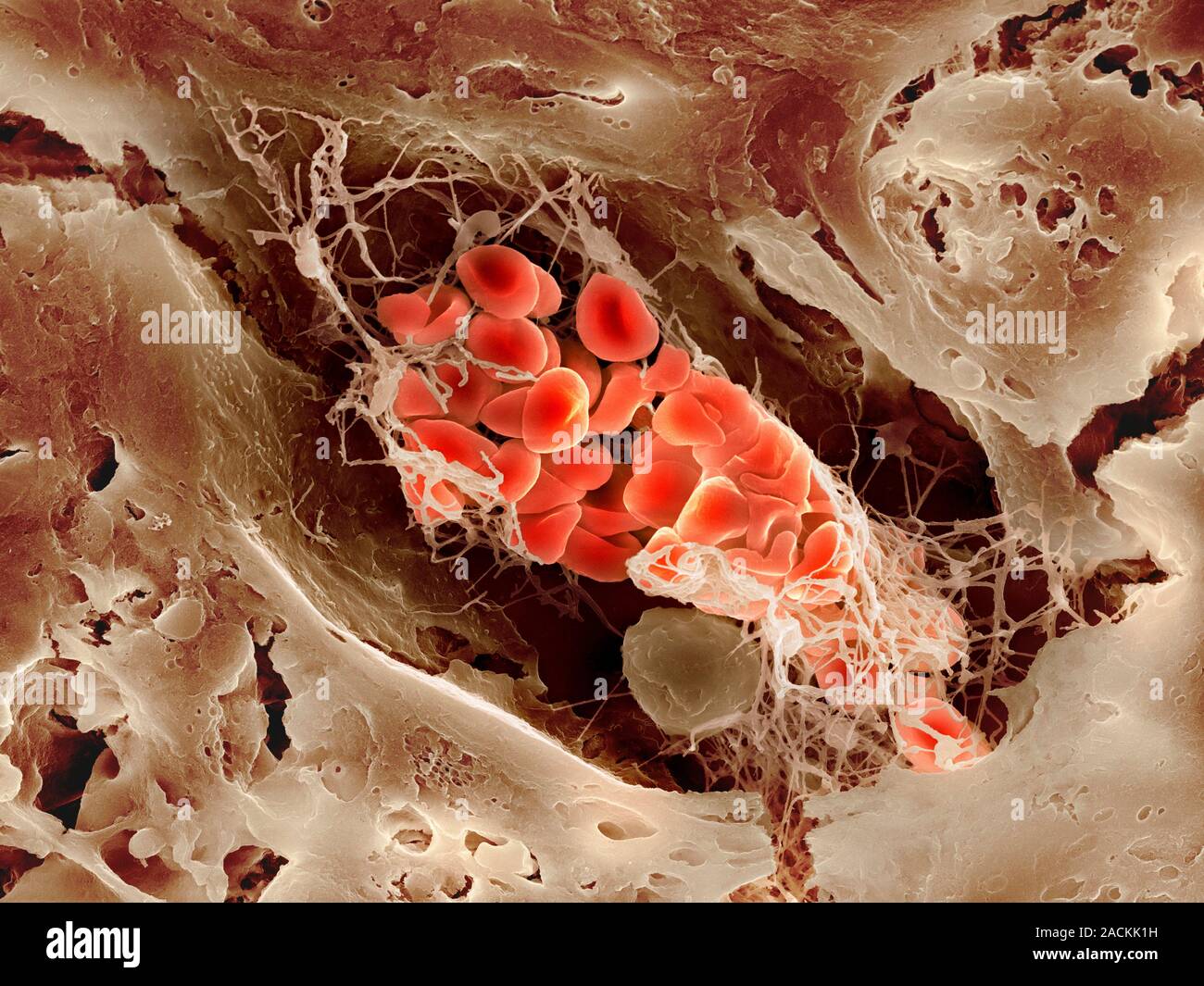 Blood clot. Coloured scanning electron micrograph (SEM) of a clot in a ...