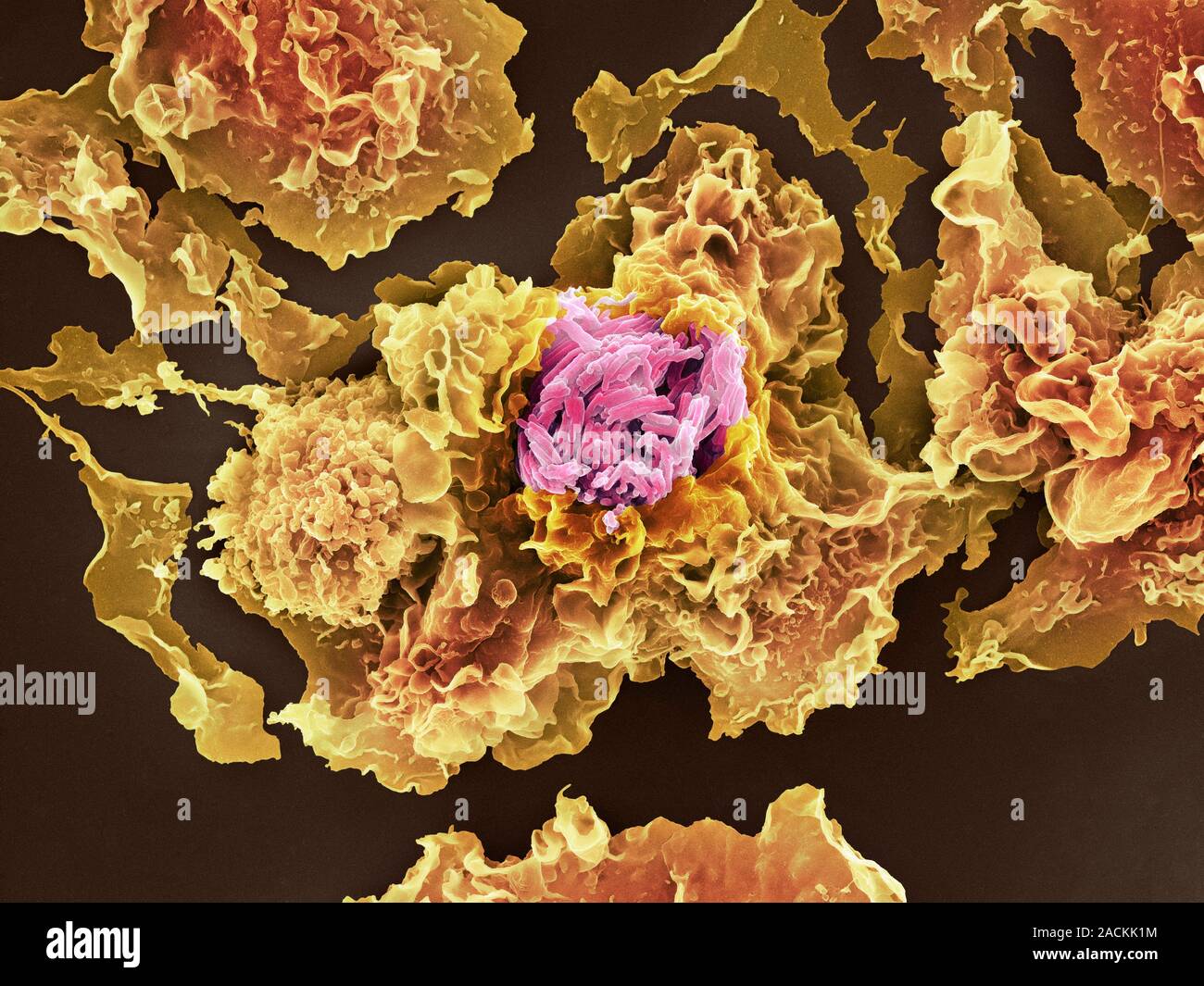 TB bacteria infecting macrophages. Coloured scanning electron ...