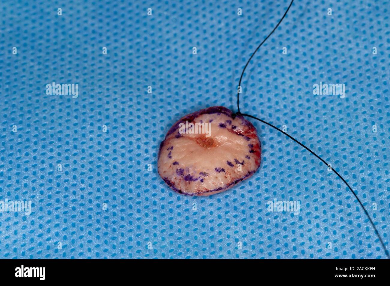 Surgically removed cancerous lesion (rodent ulcer) on the nose in an 87 ...