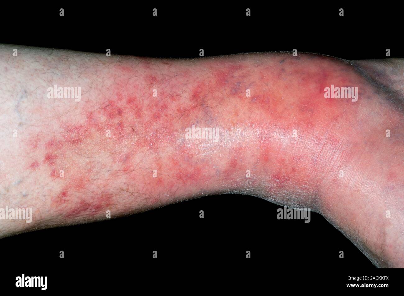 Red and inflamed shin of the leg in a 53 year old male patient showing ...