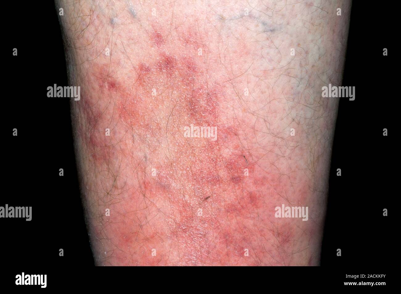Bacterial Rash On Legs