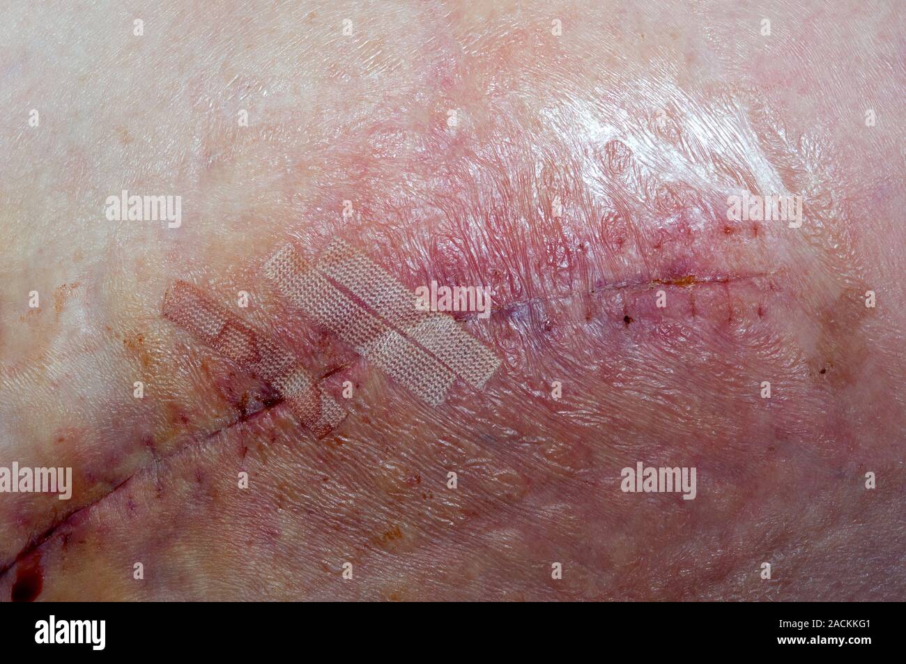 Close-up of a red and inflamed surgical wound in an 80 year old female ...