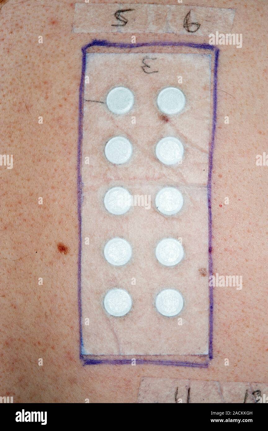 Allergy test strip on the back of an 18 year old male patient to test ...