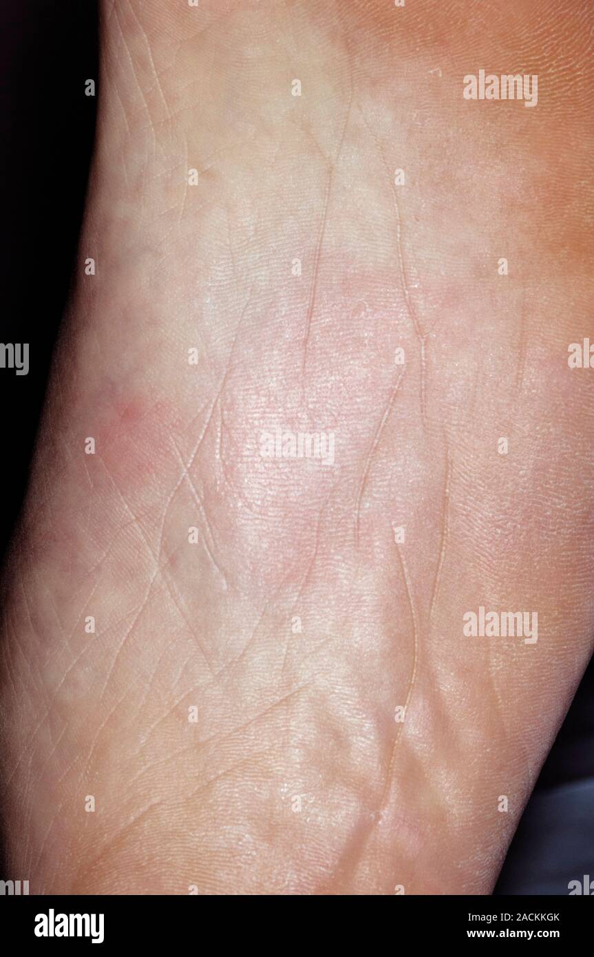 Close-up of inflamed skin on the sole of the foot in a 48 year old male ...