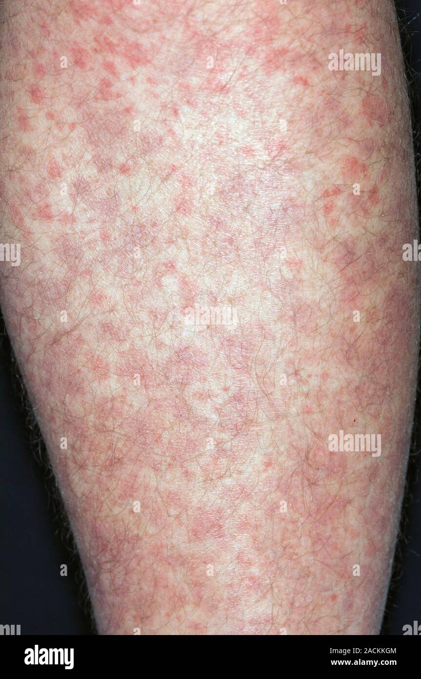 Purple rash (purpura) on the skin of the leg in a 45 year old male ...