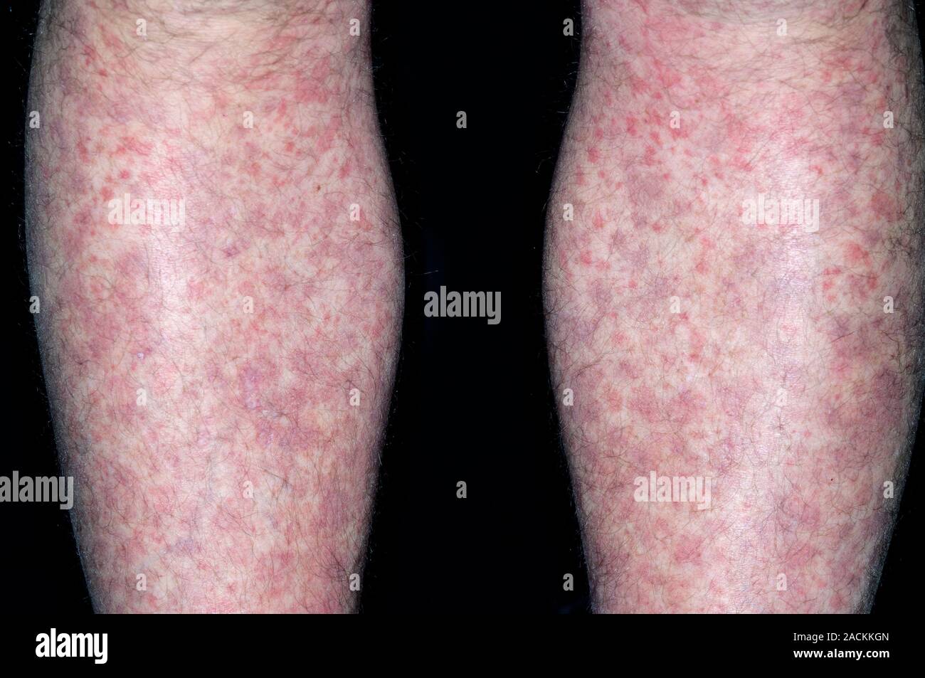 Purple rash (purpura) on the skin of the legs in a 45 year old male ...