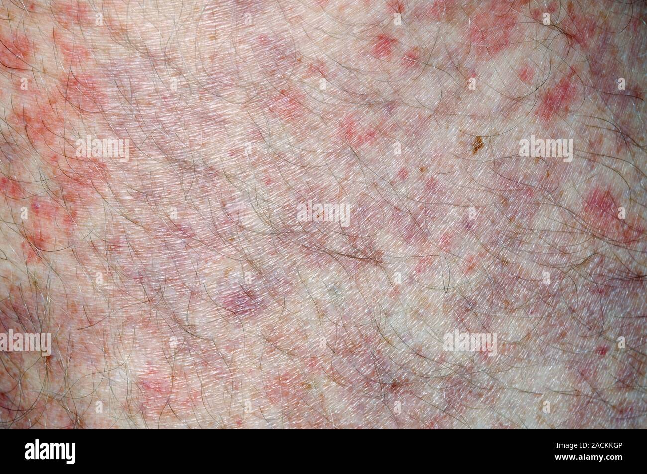 Close-up of a purple rash (purpura) on the skin of the leg in a 45 year ...