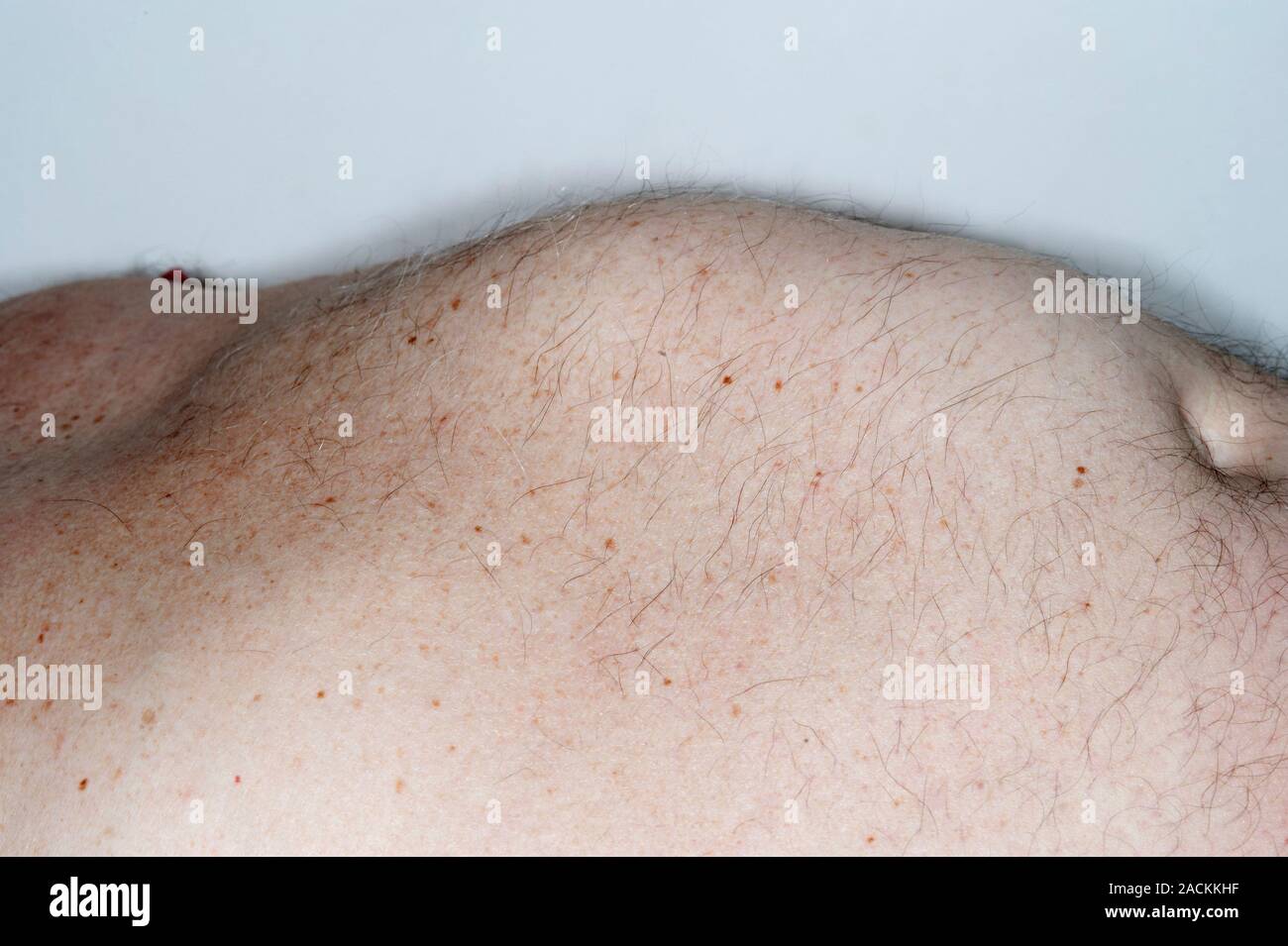 Side view of the swollen abdomen in a 71 year old male patient with an ...