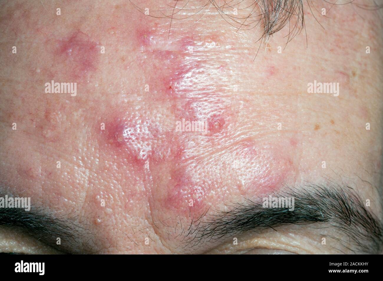 Acne rosacea on the skin of the forehead in a 57 year old male patient ...