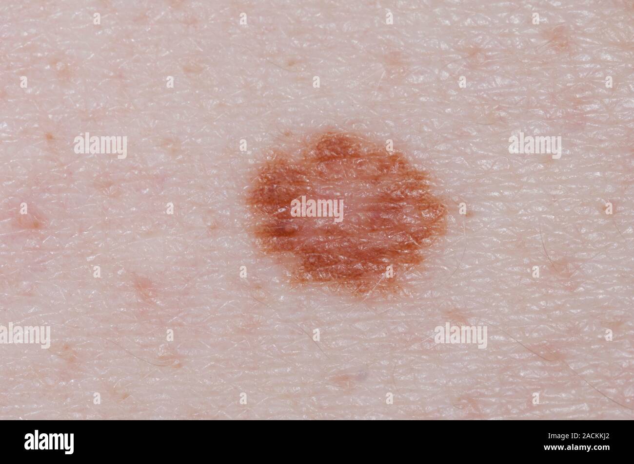 Close-up of a benign junctional mole (naevus) on the skin in a 28 year ...