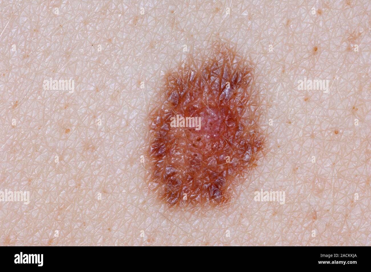 Close-up of a compound naevus (mole) on the skin in a 16 year old ...