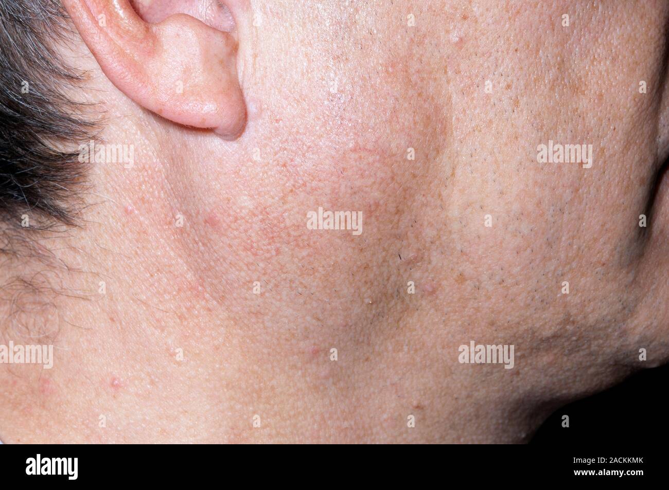 Swollen parotid (salivary) gland on the side of the jaw in a 55 year ...