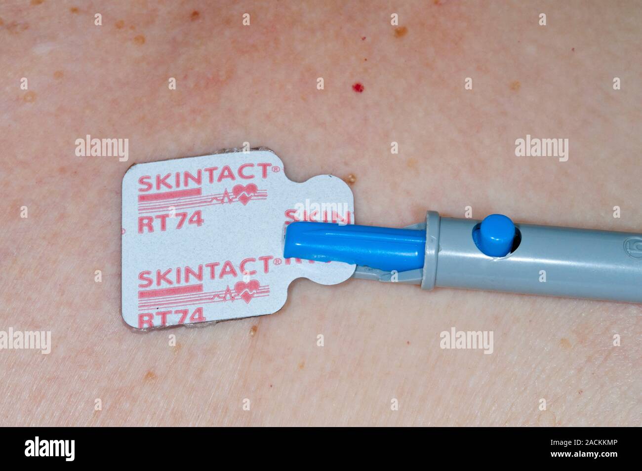 Electrode attached to the skin of the chest in an adult male patient ...