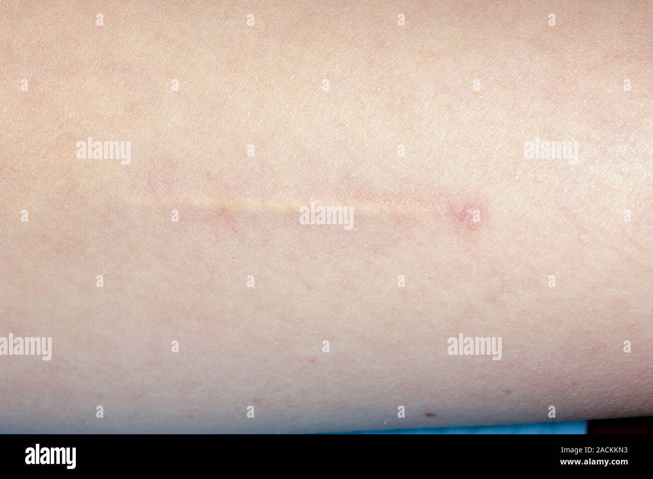 Implanon contraceptive implant under the skin of a female patient's ...