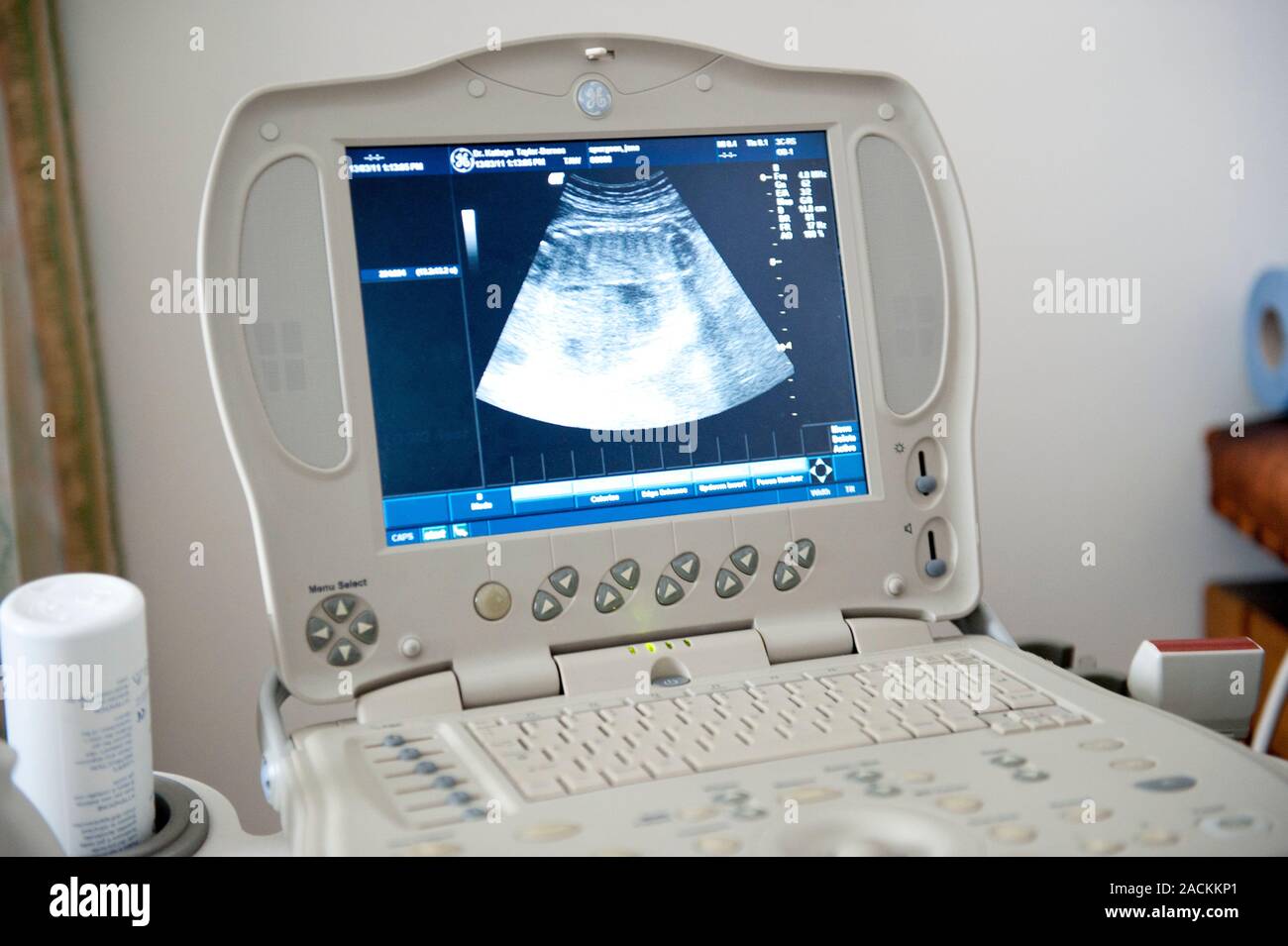 Ultrasound monitor shows a real-time scan inside the abdomen of a ...