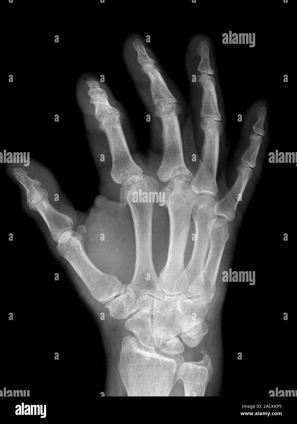 X-ray of the fingers of the hand in a 67 year old male patient showing ...