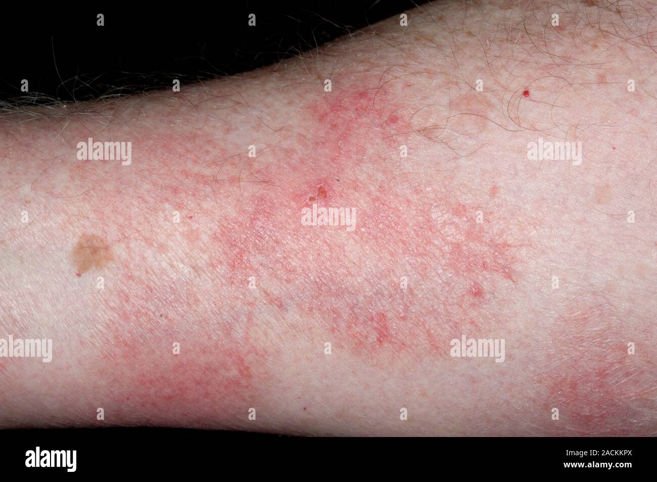 Close-up of red patches on the skin of the leg in a 66 year old male ...