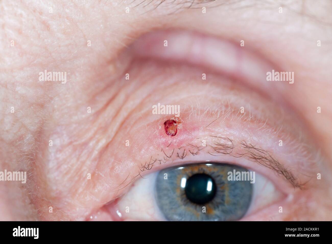 Close-up of basal cell carcinoma (skin cancer) on the upper eyelid in a ...