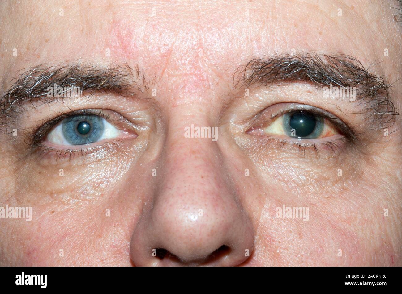 Close-up of the dilated pupil (at right) of the eye in a 56 year old ...