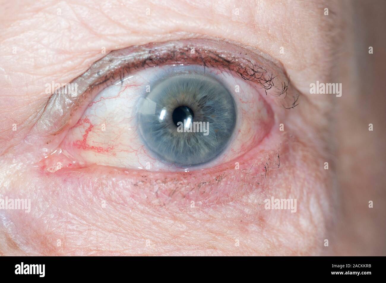 Exophthalmos Vs Proptosis