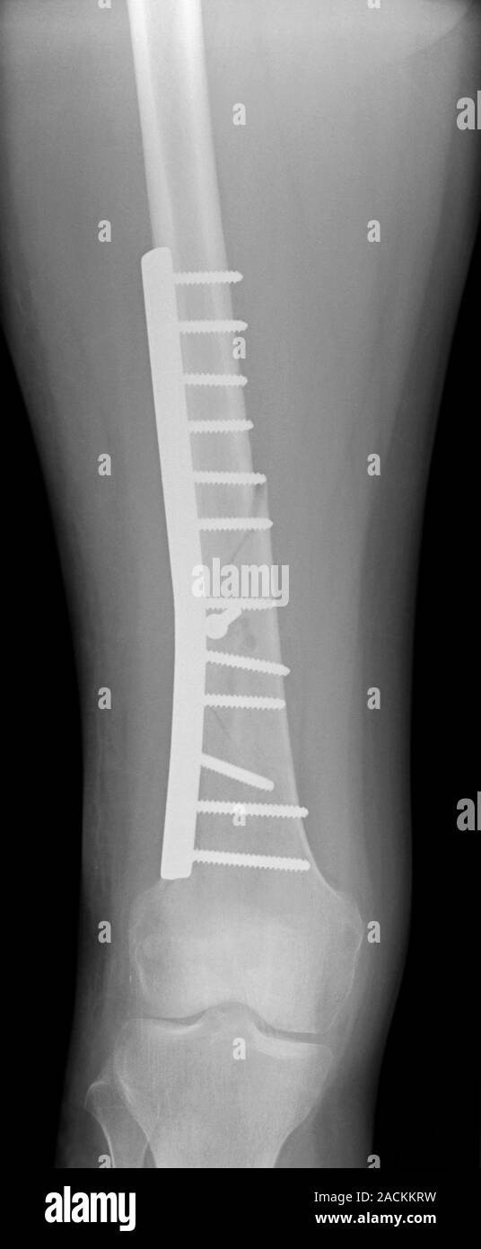 X-ray of the broken femur (leg bone) in a 25 year old female patient ...