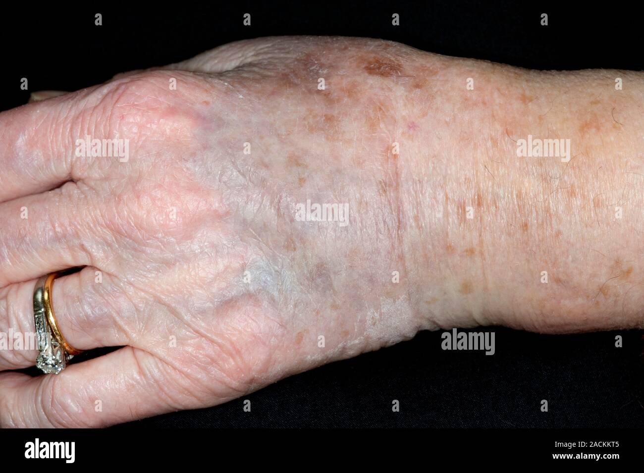 Bruising (haematoma) of the wrist in an 82 year old female patient from ...