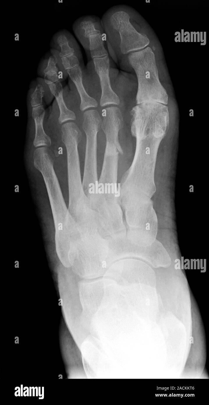 X-ray (top view) of the broken foot in a 63 year old male patient ...