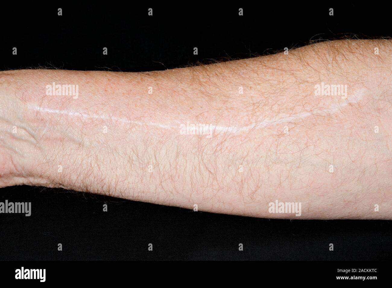 Scar along the length of the forearm in an adult male patient from ...
