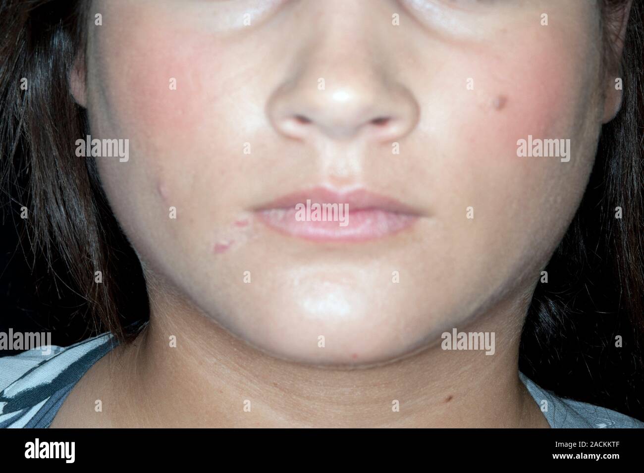 Swollen parotid glands in a 20 year old female patient with mumps ...