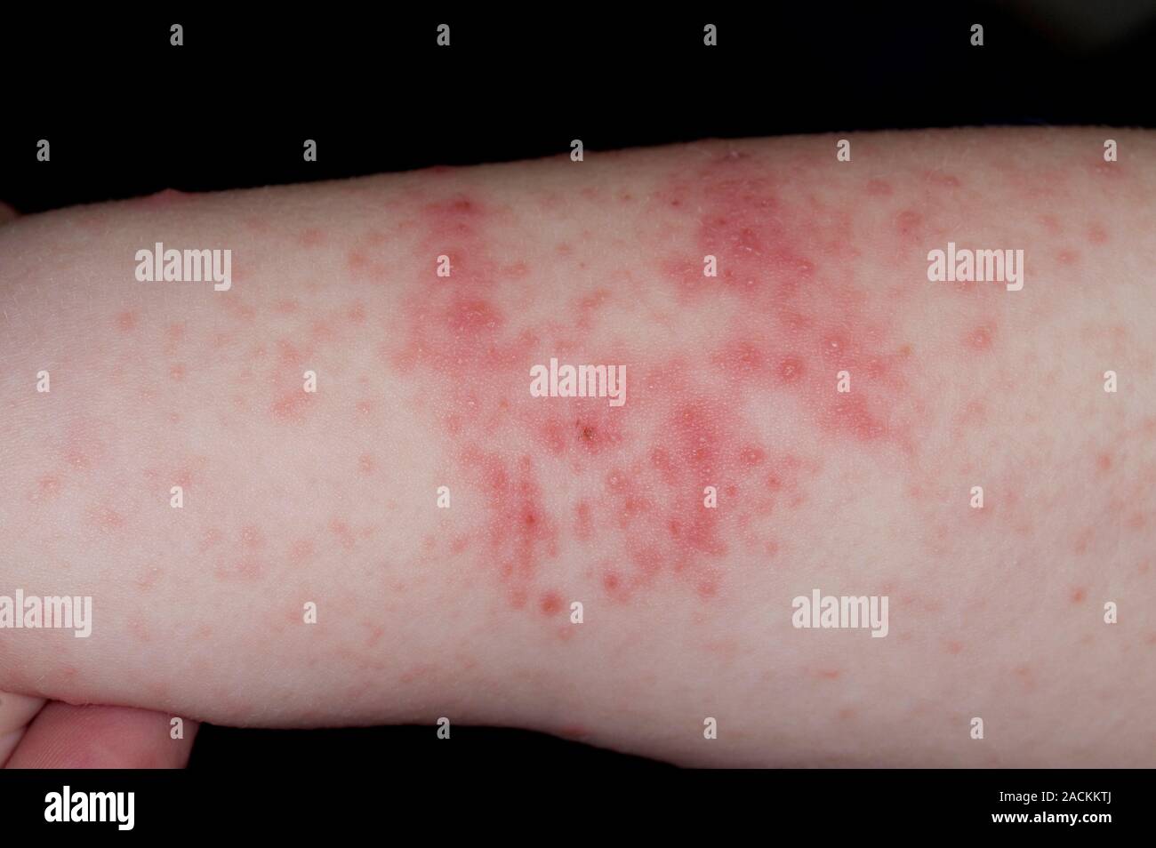 Lesions forming a skin rash on the arm in a two year old male patient ...