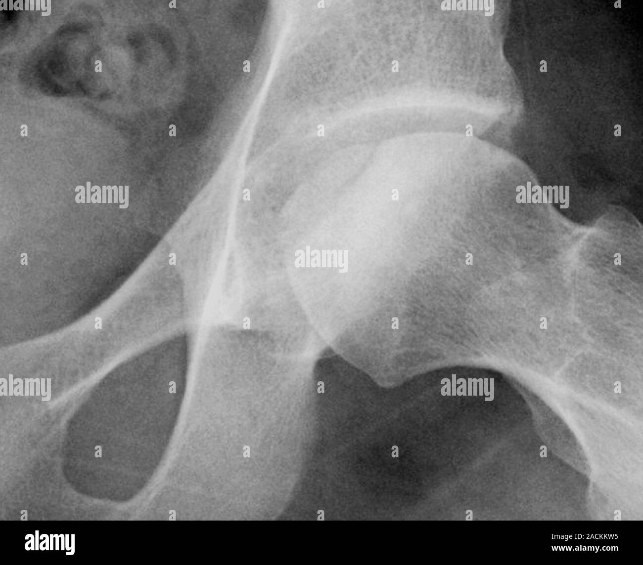 Osteonecrosis. X-ray of the hip joint of a 21-year-old man showing ...