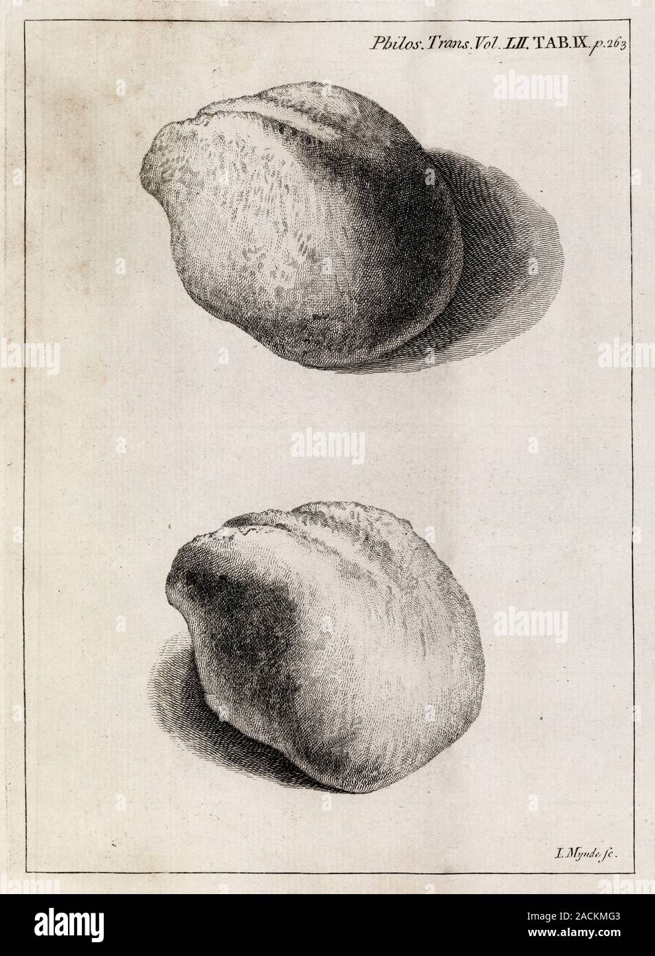 Kidney stone. 18th-century journal page illustrating two views of a ...