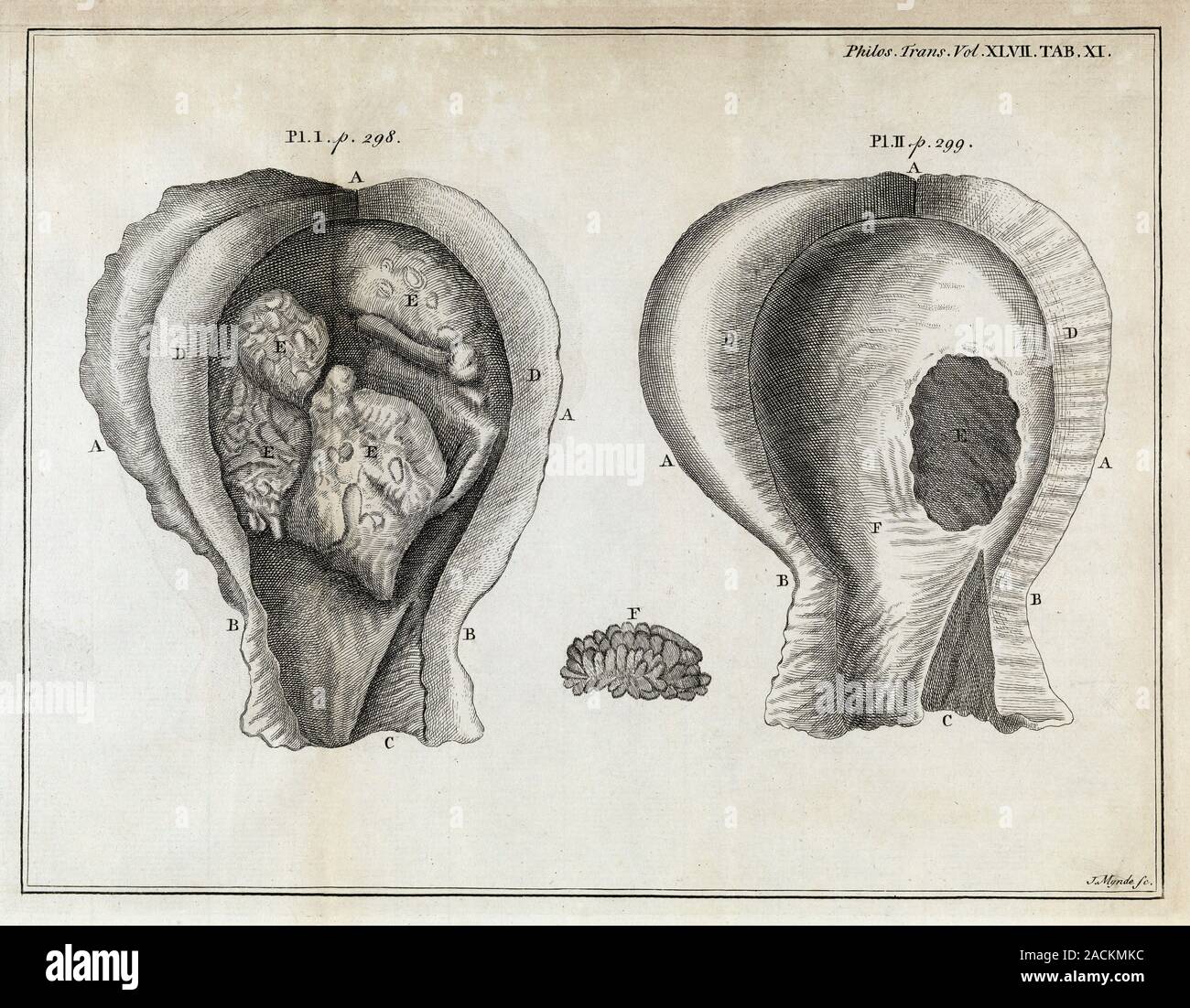 Fungal bladder infection. 18th-century journal page showing fungal ...