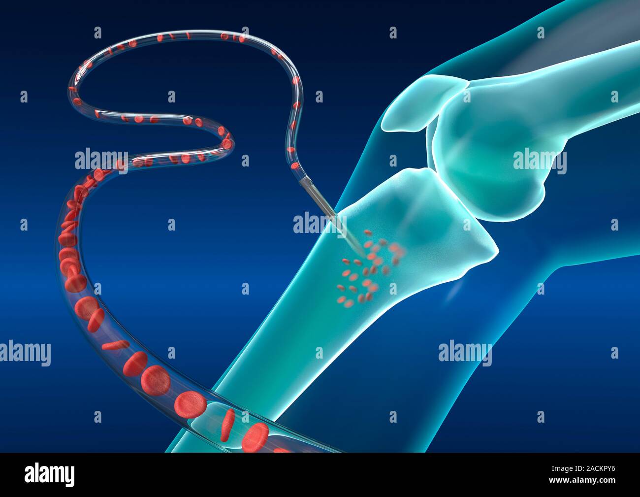 Intraosseous infusion. Computer artwork of a blood transfusion being ...