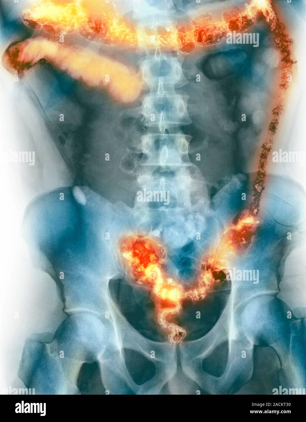 Ulcerative colitis. Coloured X-ray of the abdomen of a 30 year old man with ulcerative colitis ...