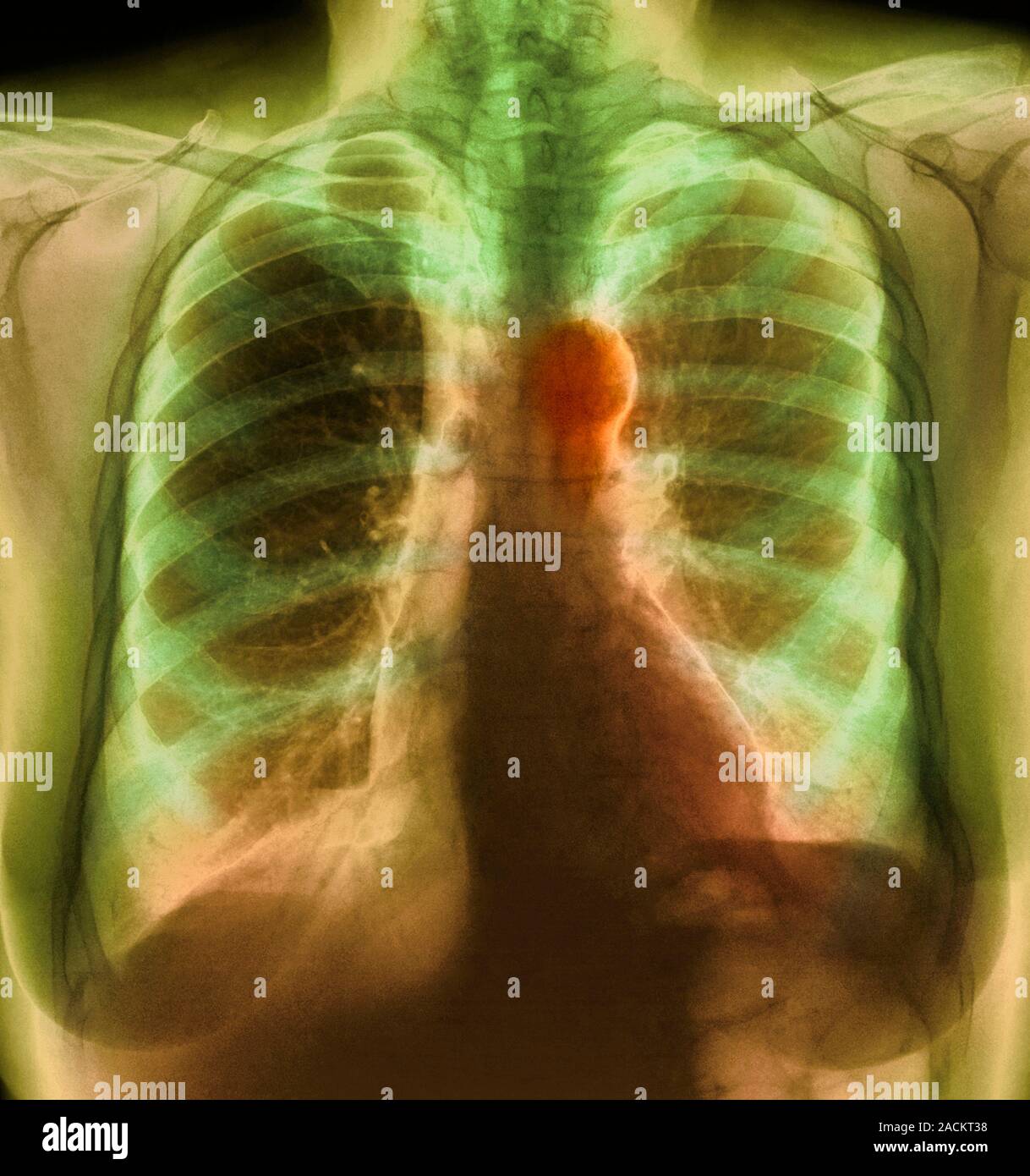 Aortic aneurysm. Coloured X-ray of the chest of a 68 year old woman ...